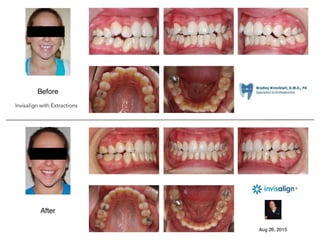 Austin Invisalign process presentation | PPT