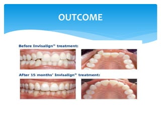 Austin Invisalign process presentation | PPT