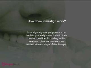 Invisalign FAQS | PPTX