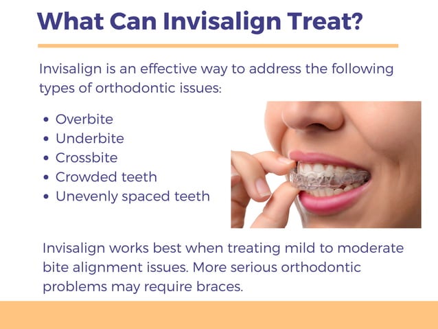 Your Guide to Invisalign | PDF