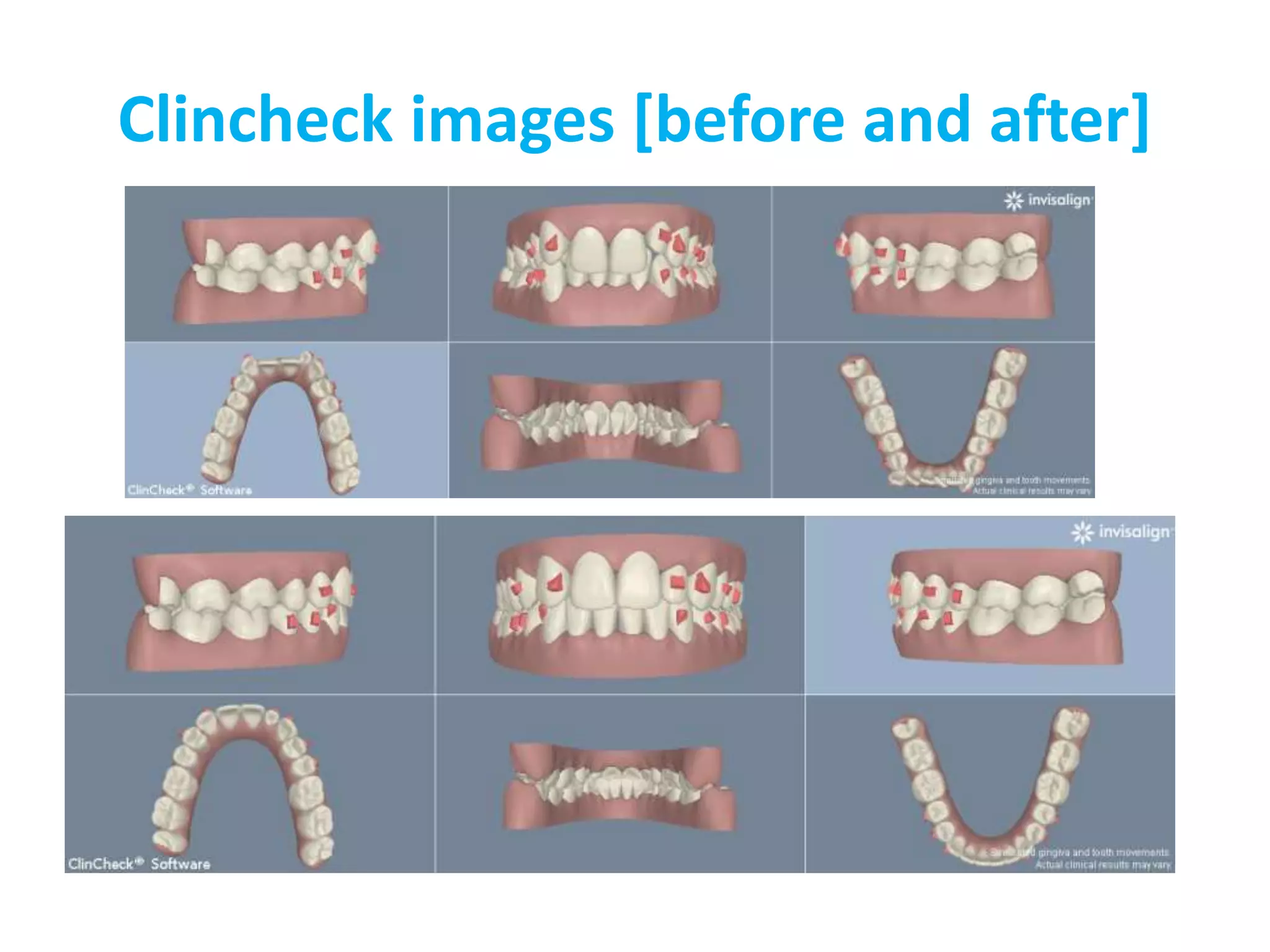 Invisalign case #1 | PPTX