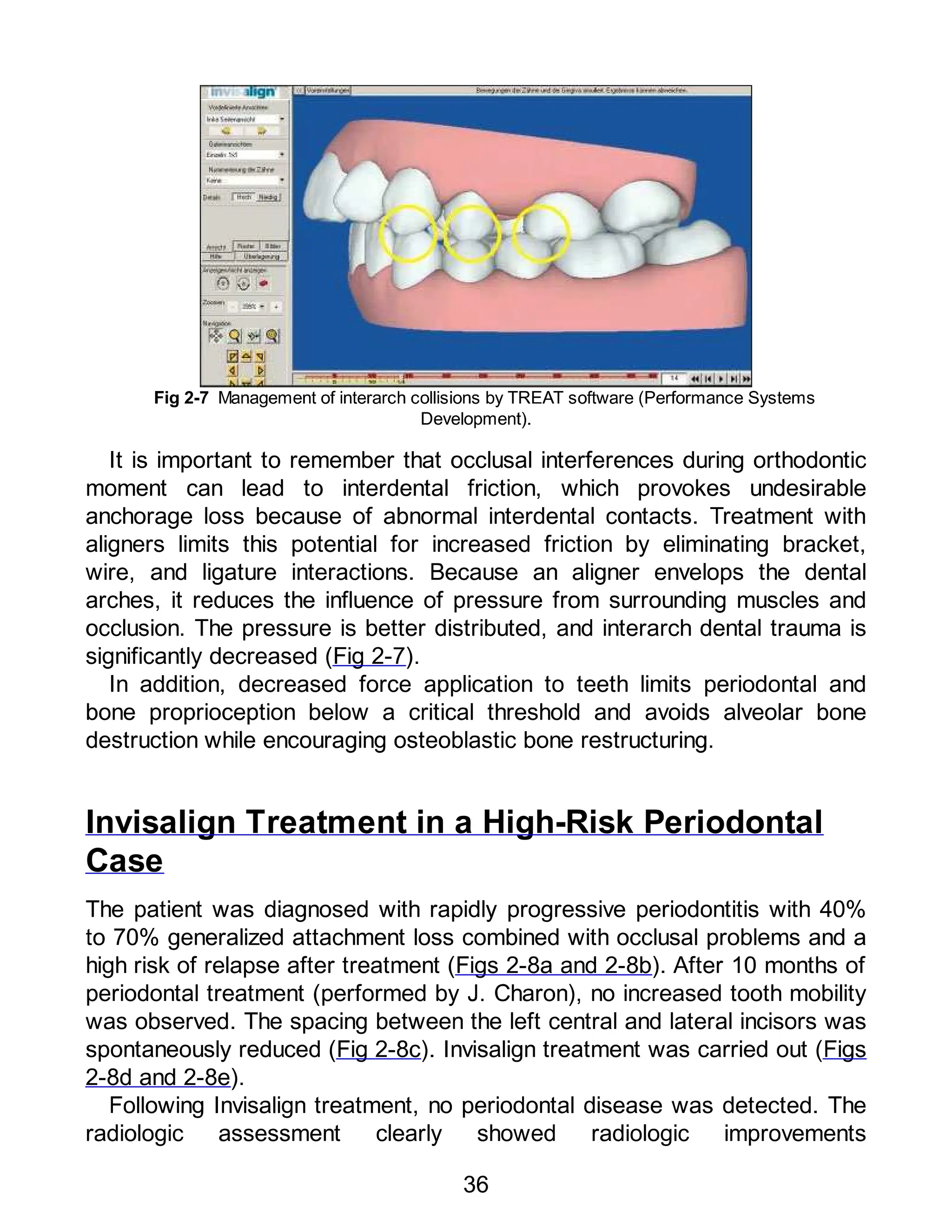 invisalign in orthodontic treatments .PDF