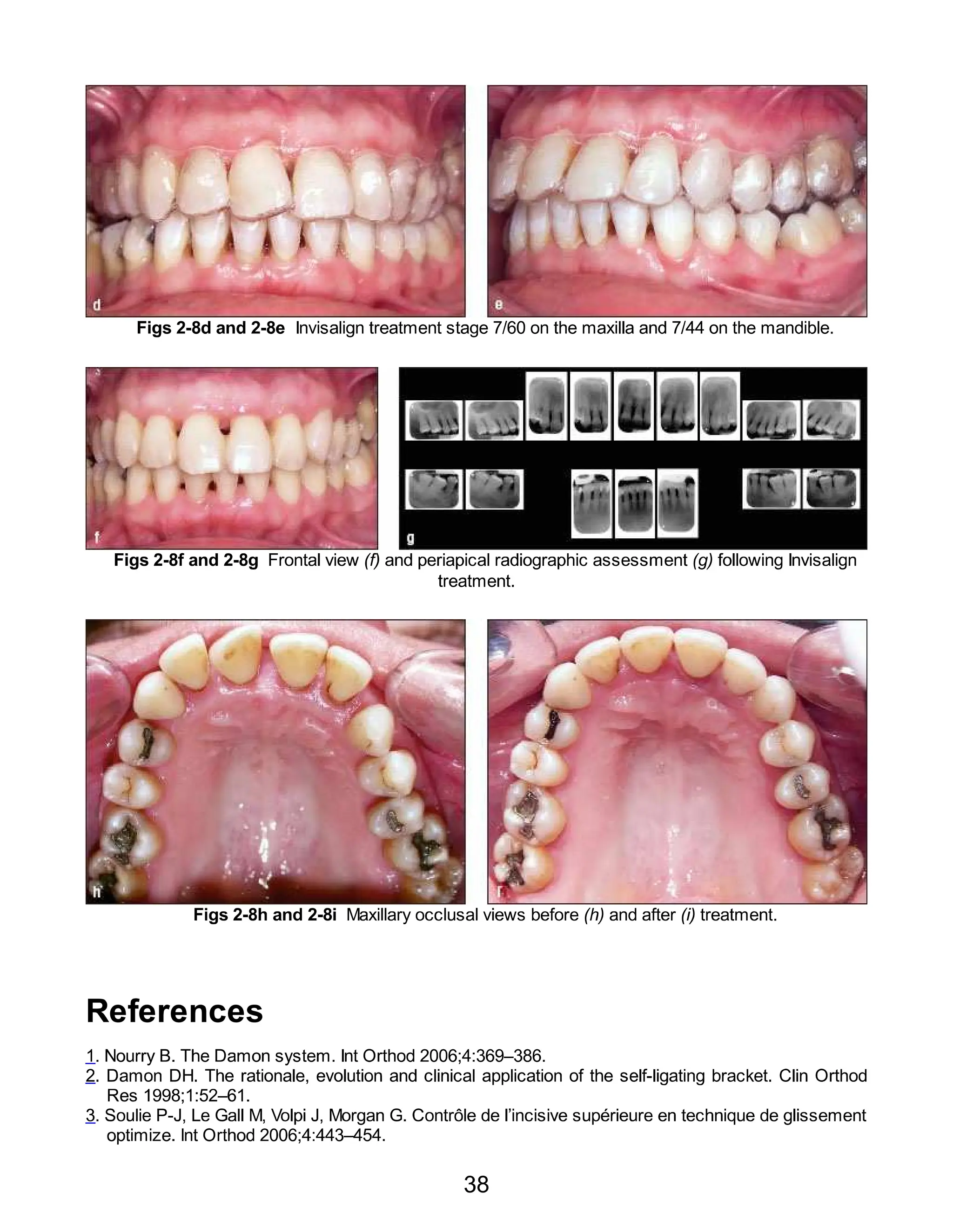 invisalign in orthodontic treatments .PDF