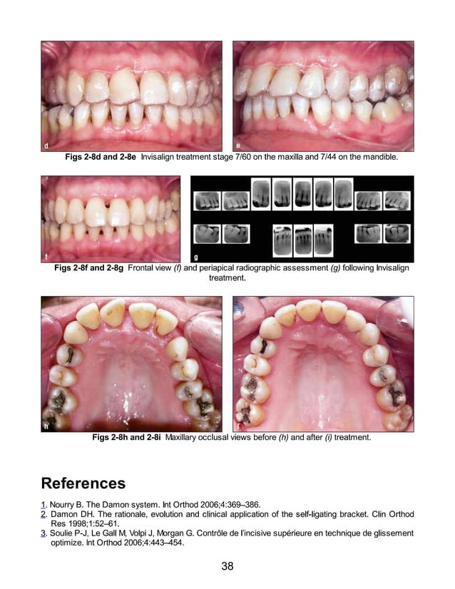 invisalign in orthodontic treatments .PDF