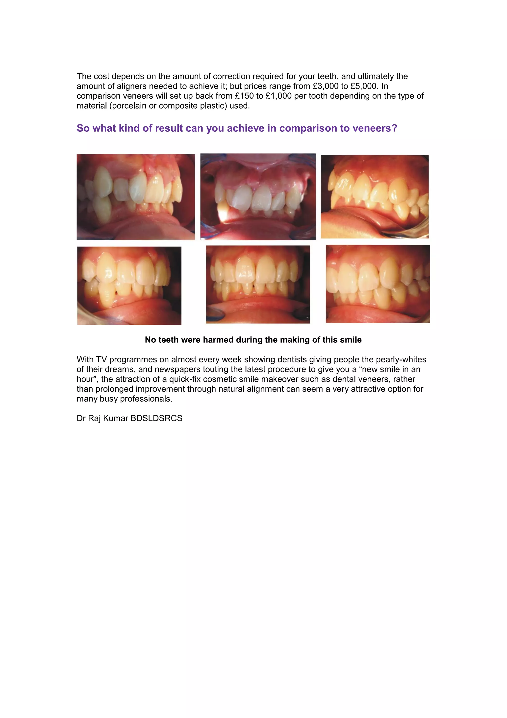 Invisalign orthodontics | PDF