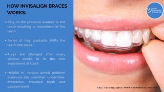 Invisalign treatment | PDF