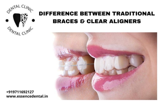 Invisible Aligners Cost, Clear Aligners | PDF