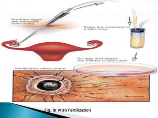In vitro fertilization and embryo transfer in humans | PPTX