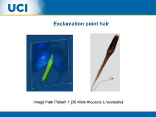 In Vivo Imaging in Alopecia Areata Patients Using Multiphoton ...