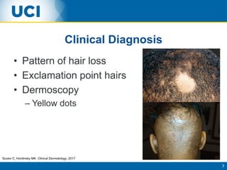 Alopecia Areata Exclamation Point Hair