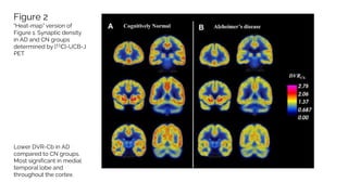 In vivo measurement of widespread synaptic loss in Alzheimer’s Disease with SV2A PET (2).pptx