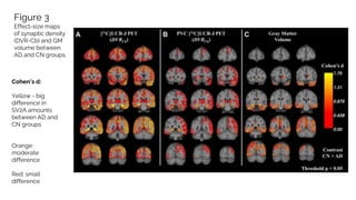 In vivo measurement of widespread synaptic loss in Alzheimer’s Disease with SV2A PET (2).pptx