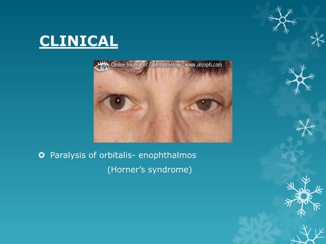 Involuntary extraocular muscles | PPT