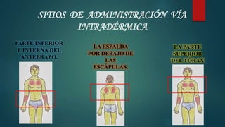 Inyeccion intradermica final | PPTX