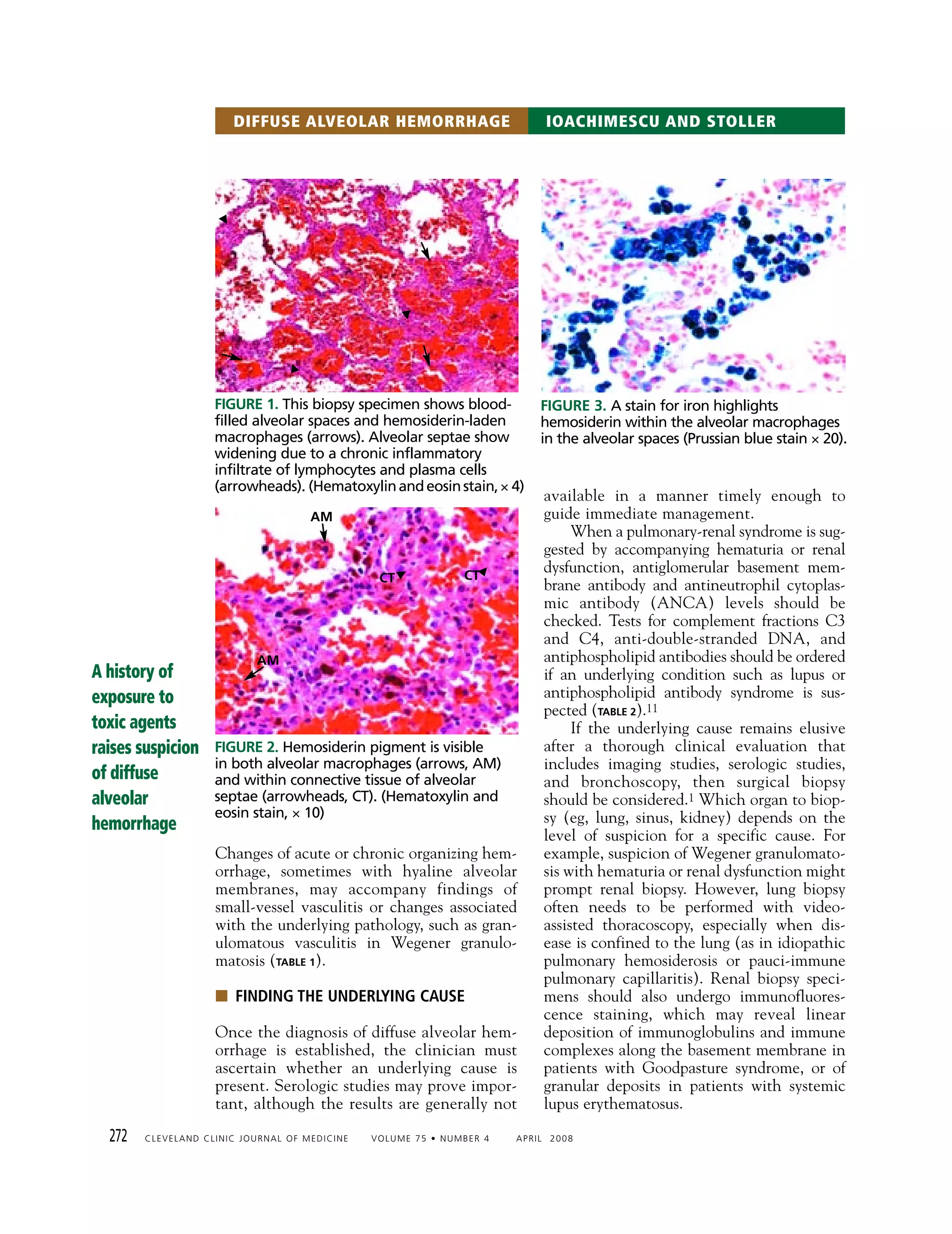 Hemorragia Alveolar Difusa | PDF