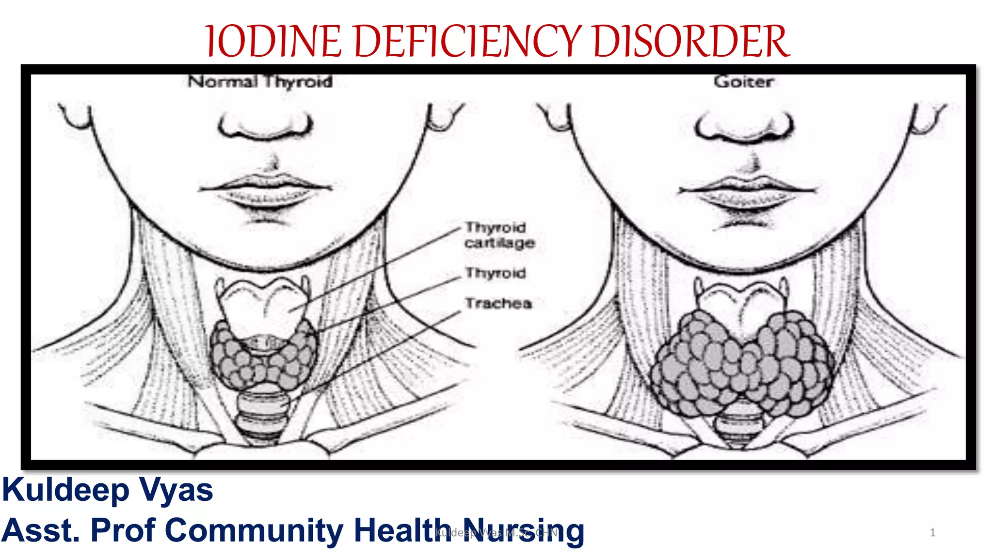 Iodine Deficiency | PPTX