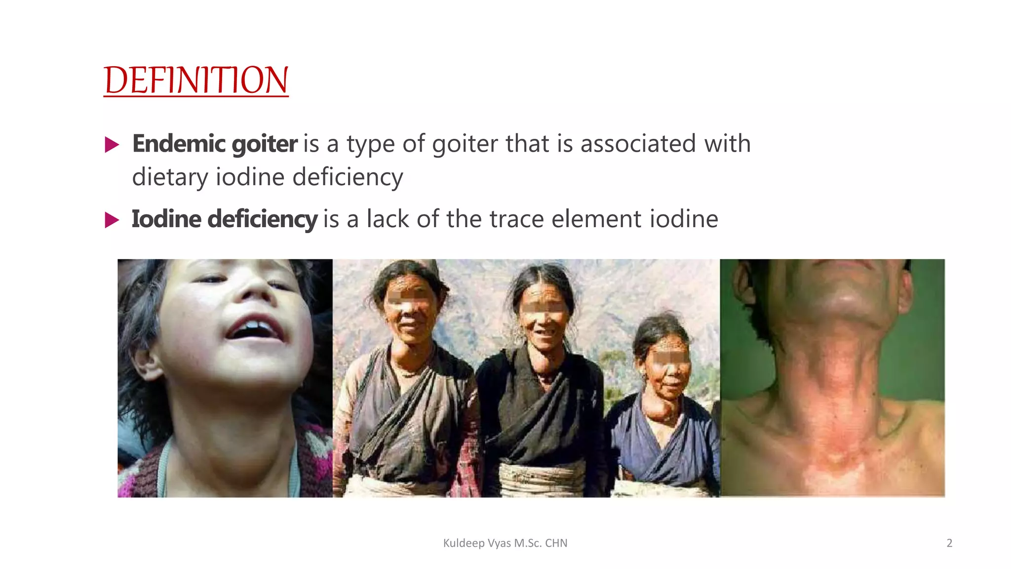 Iodine Deficiency | PPTX