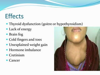 Iodine deficiency | PPTX