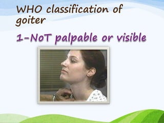 Iodine deficiency disorders of thyroid gland | PPT