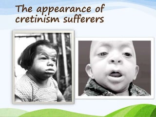 Iodine Deficiency Cretinism