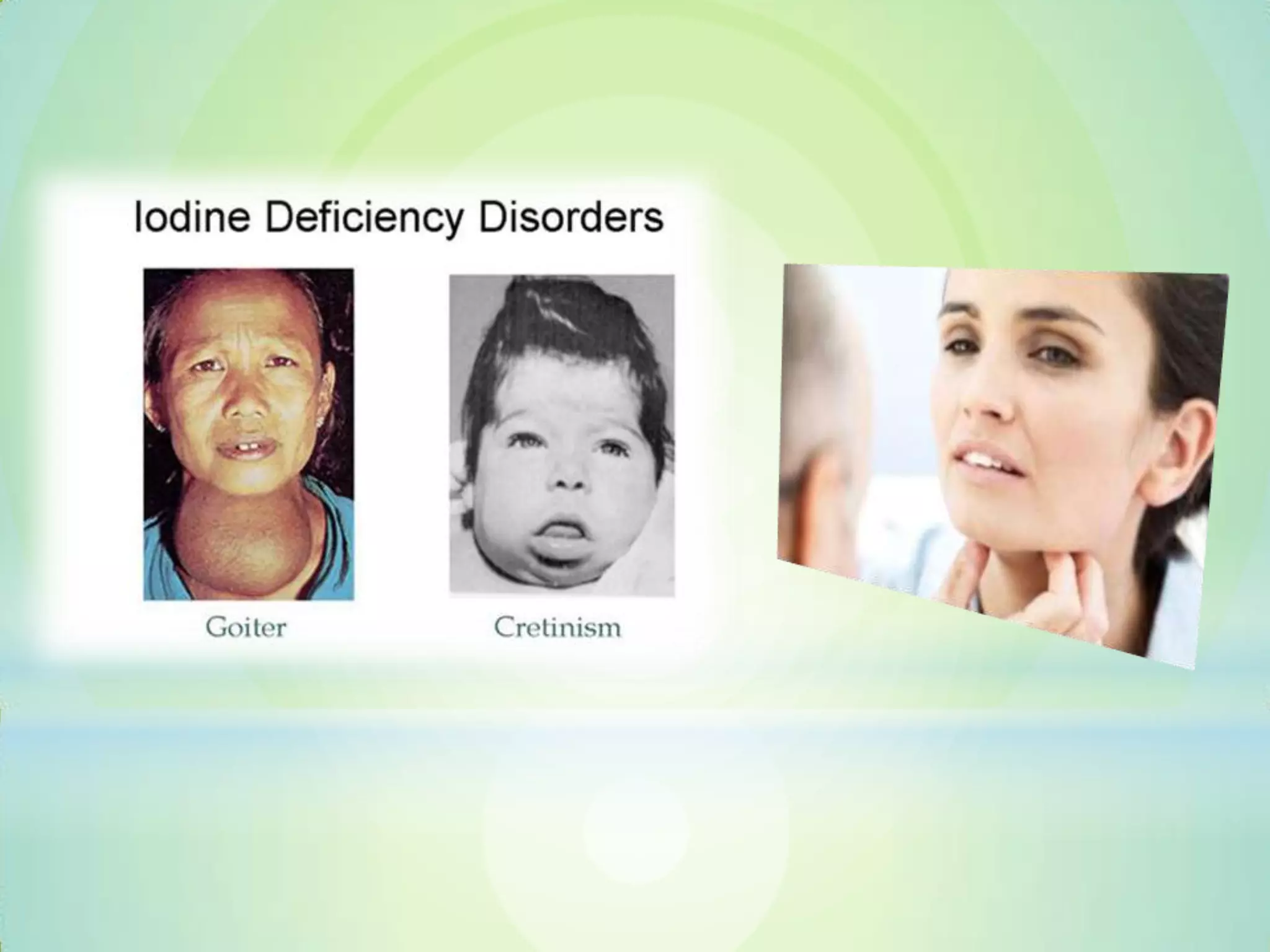 Iodine deficiency symptoms | PPTX