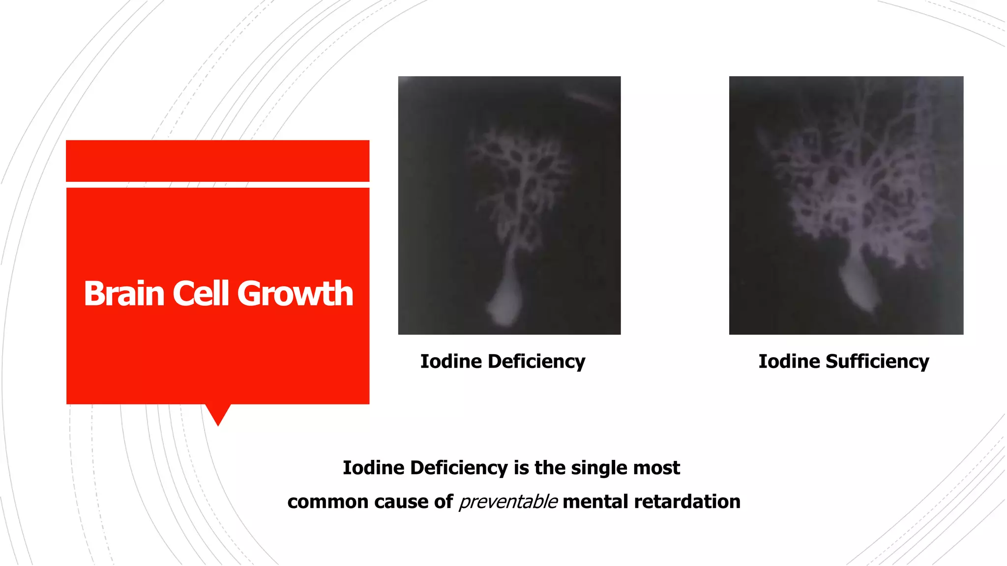 Iodine for mother and fetus | PPTX