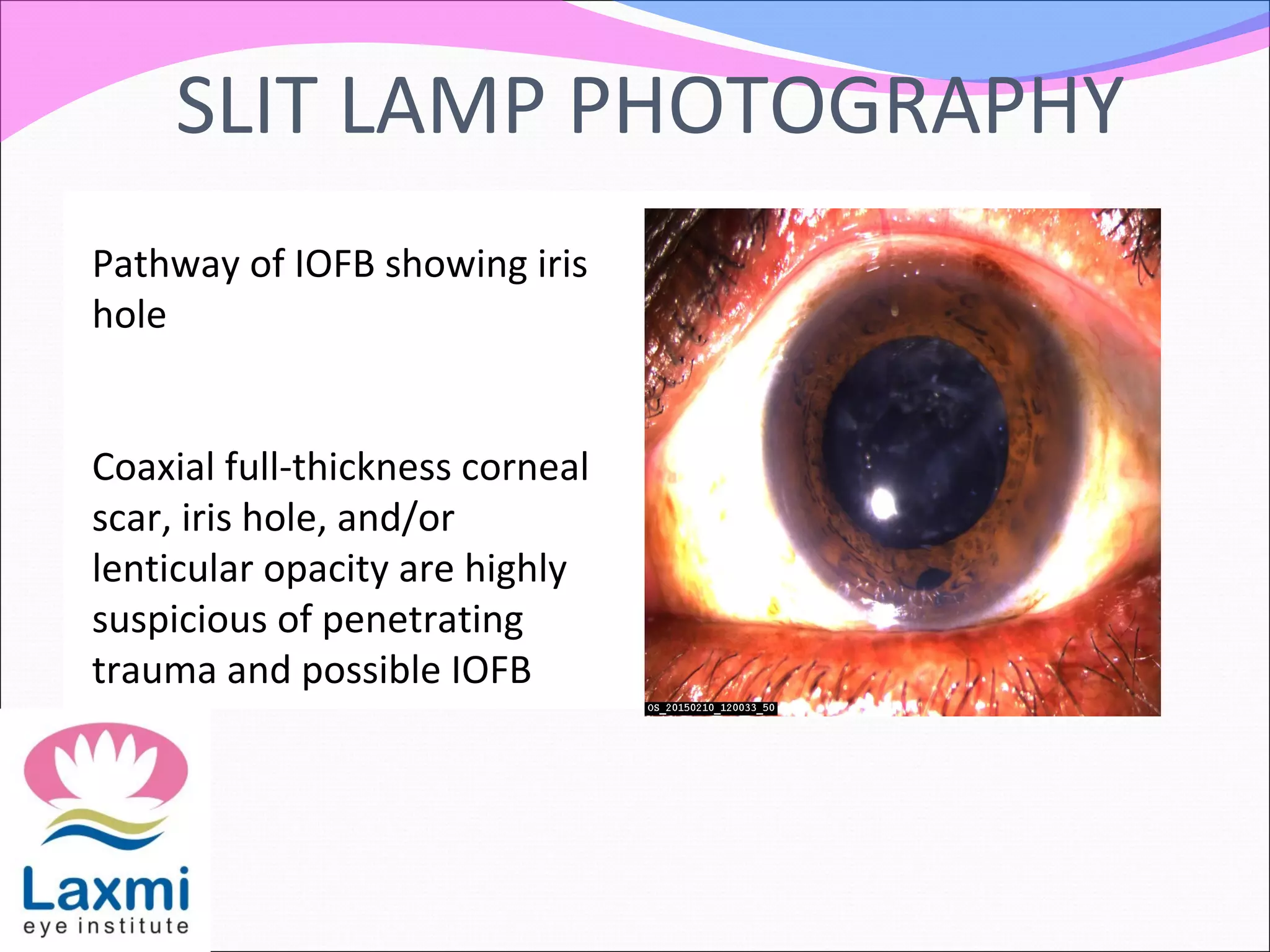 INTRAOCULAR FOREIGN BODY | PPT
