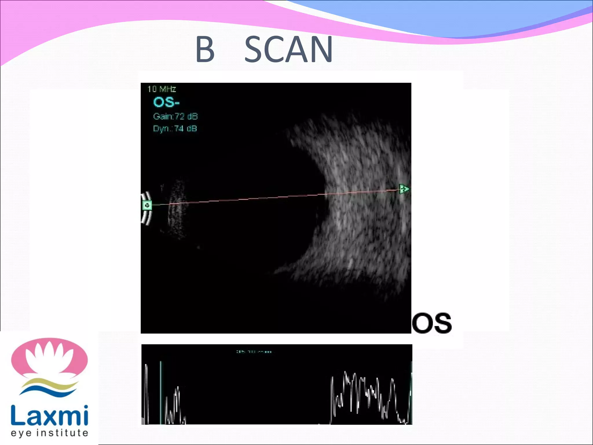 INTRAOCULAR FOREIGN BODY | PPT