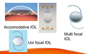 Intaoccular lens | PPT