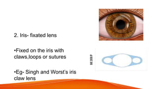 Intaoccular lens | PPT