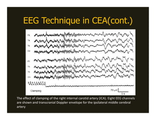Iom during carotid endarterectomy 2008 | PDF