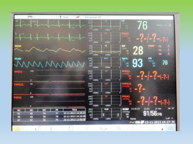 Intraoperative Monitoring for Brain and Spinal Cord Tumors | PPTX