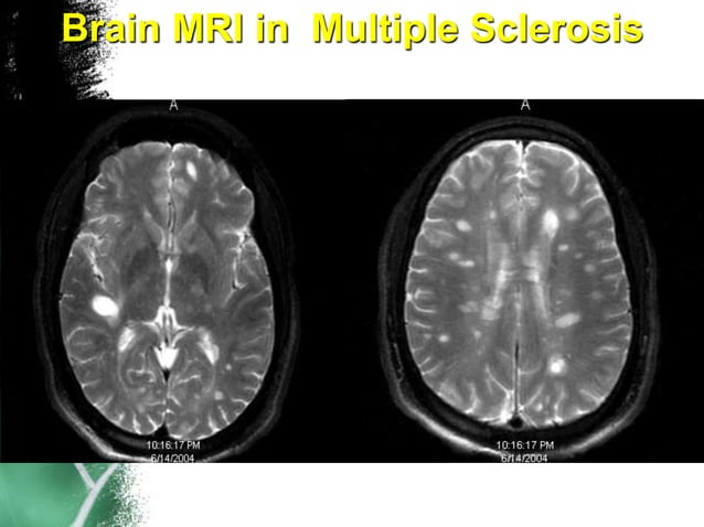 Multiple sclerosis case scenario study based | PPT | Physical Therapy ...
