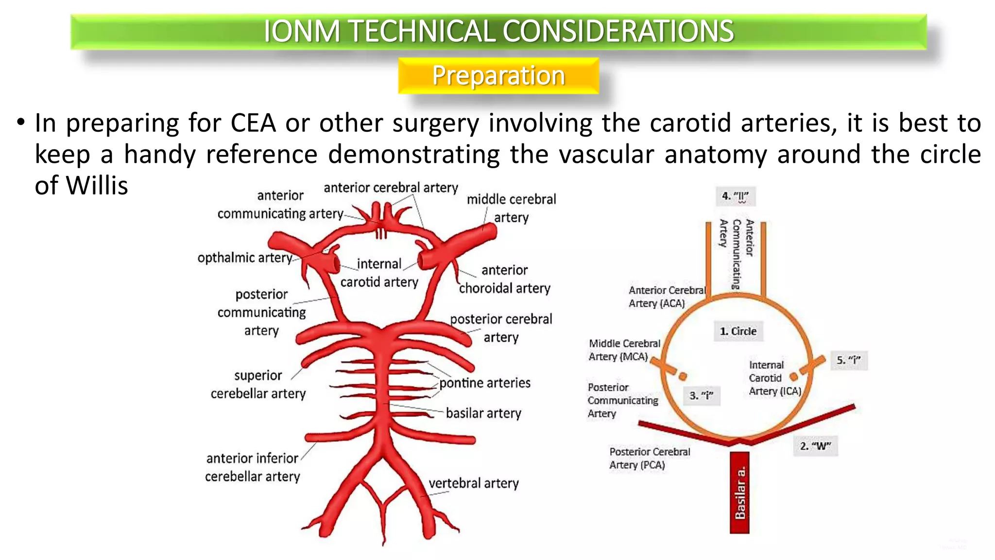 IONM for Carotid Surgery & Carotidendartectomy | PPT