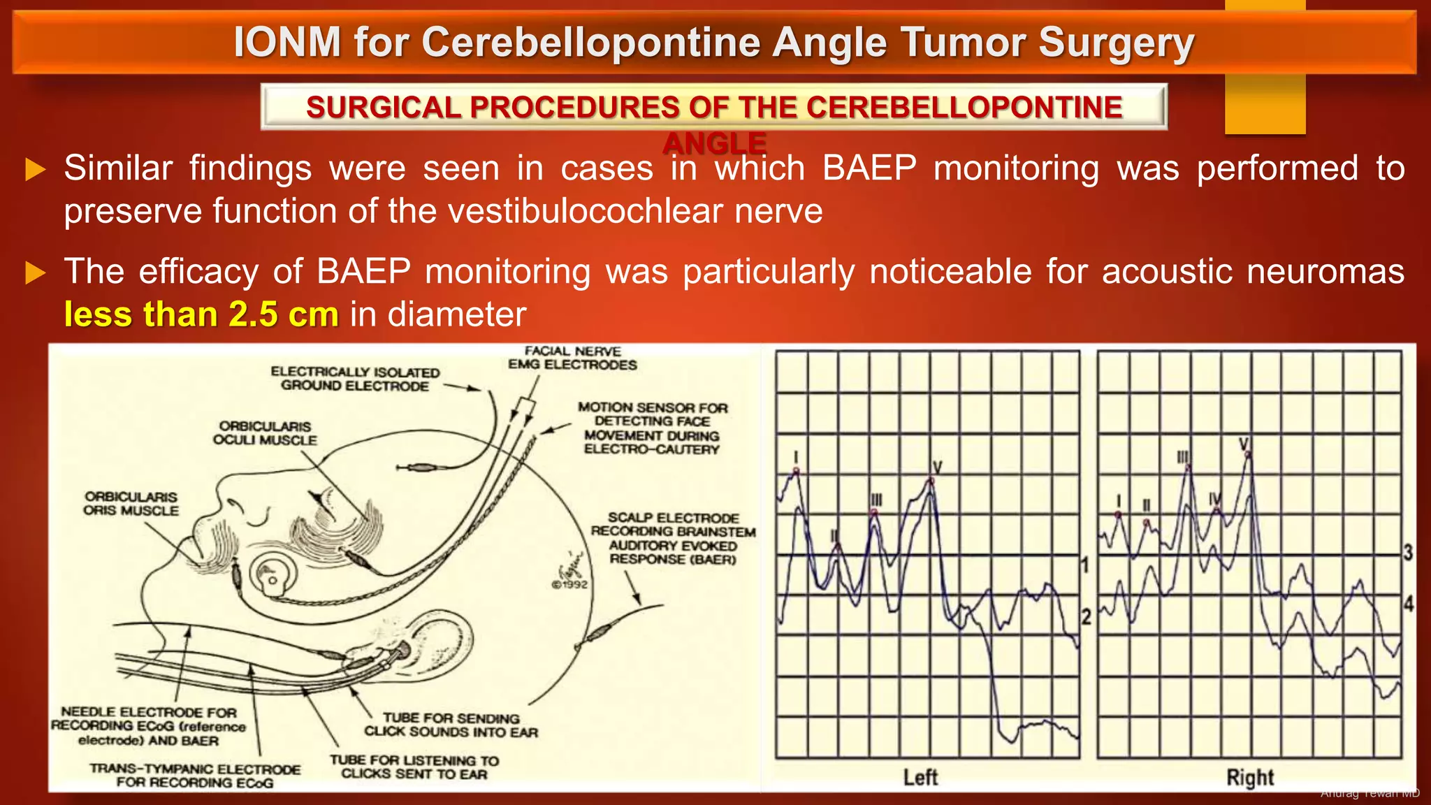 IONM for Cerebellopontine Angle Tumor Surgery | PPTX