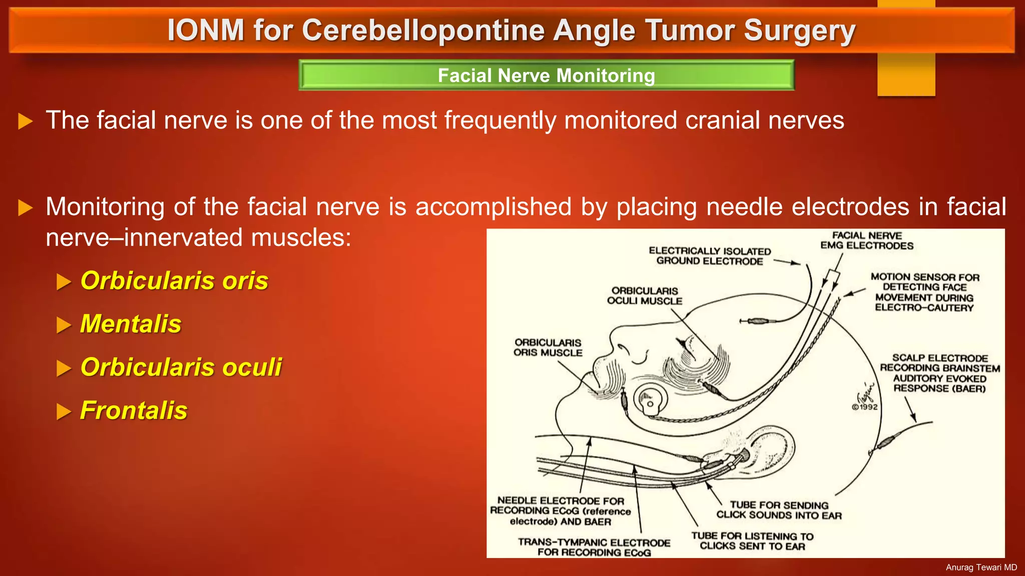IONM for Cerebellopontine Angle Tumor Surgery | PPTX