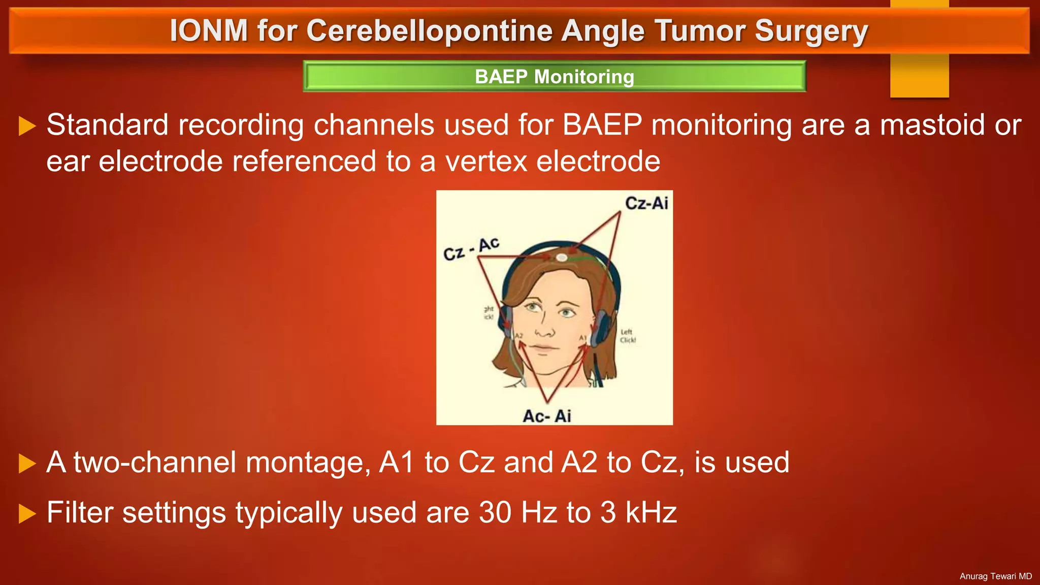 IONM for Cerebellopontine Angle Tumor Surgery | PPTX