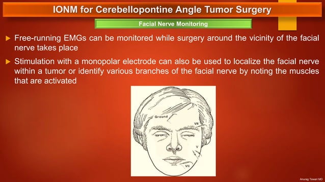 IONM for Cerebellopontine Angle Tumor Surgery | PPTX | Ear, Nose and ...