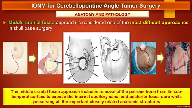 IONM for Cerebellopontine Angle Tumor Surgery | PPTX | Ear, Nose and ...