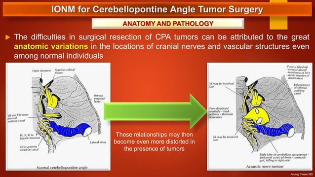 IONM for Cerebellopontine Angle Tumor Surgery | PPTX | Ear, Nose and ...