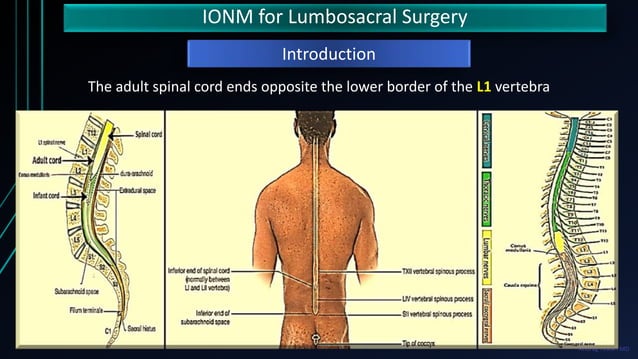 IONM for Lumbosacral Surgery | PPTX