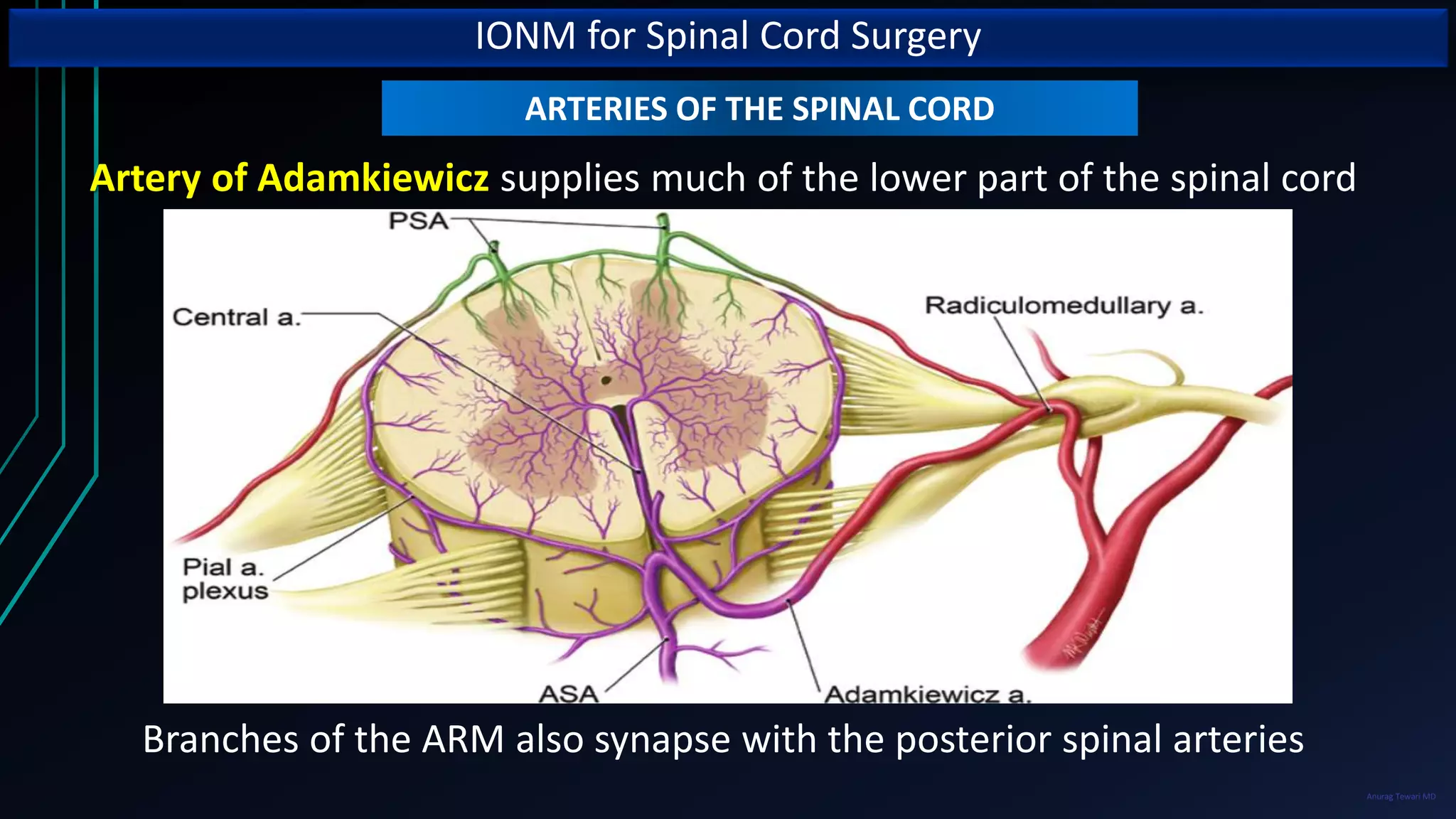 IONM for Spinal Cord Surgery | PPTX