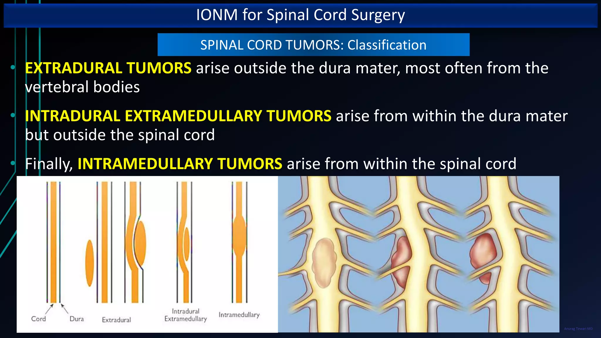 IONM for Spinal Cord Surgery | PPTX