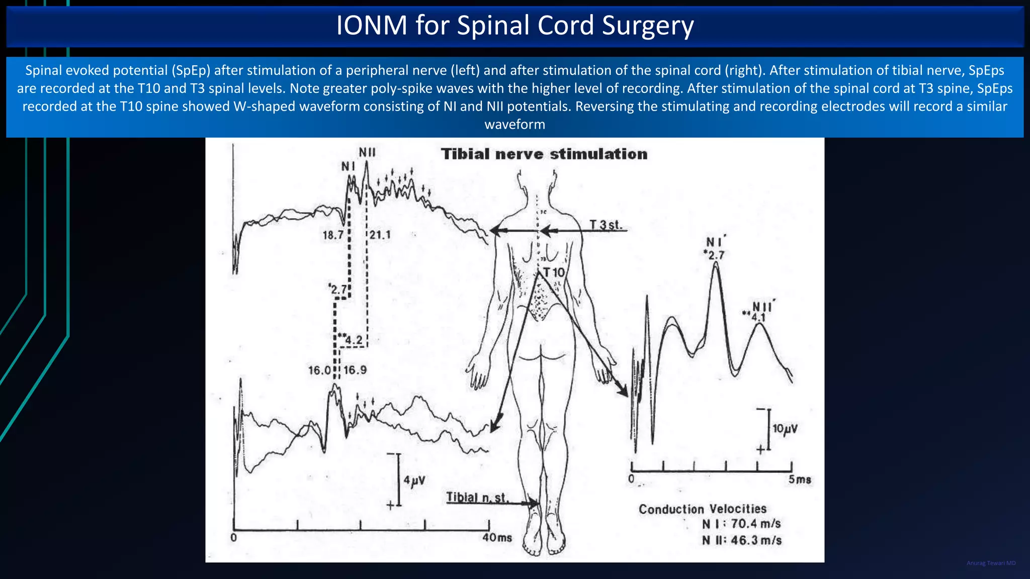 IONM for Spinal Cord Surgery | PPTX