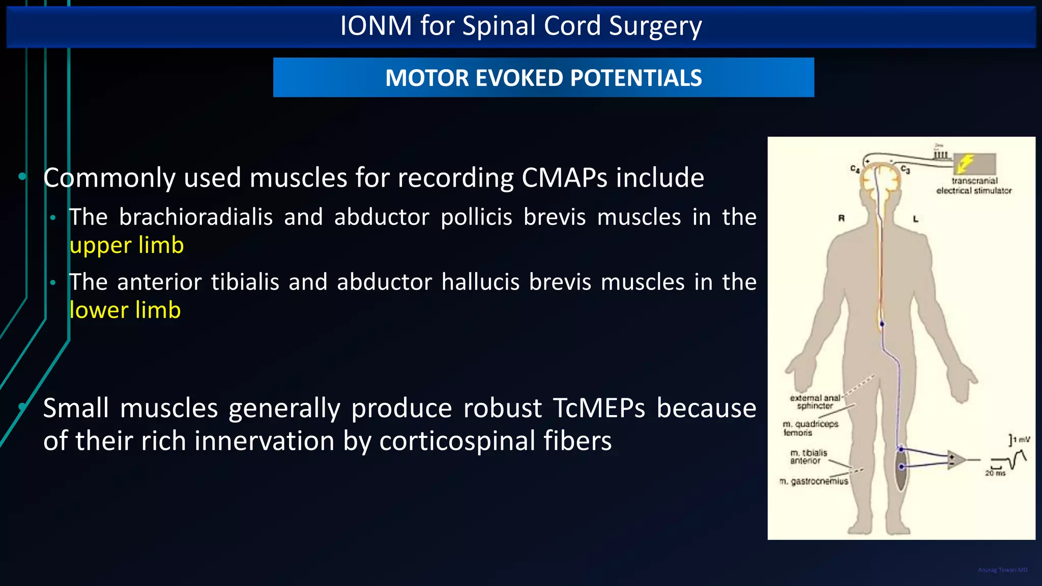 IONM for Spinal Cord Surgery | PPTX