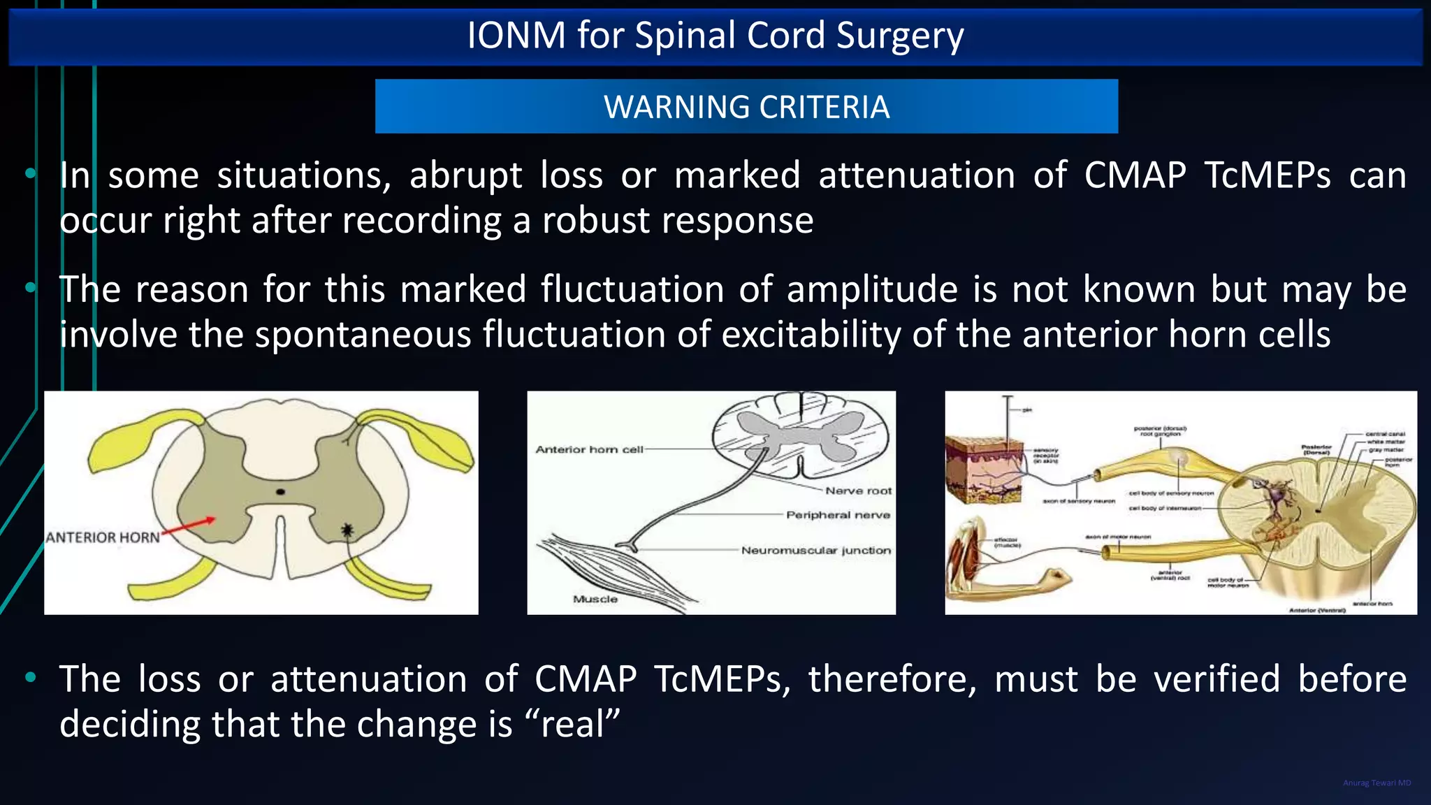 IONM for Spinal Cord Surgery | PPTX