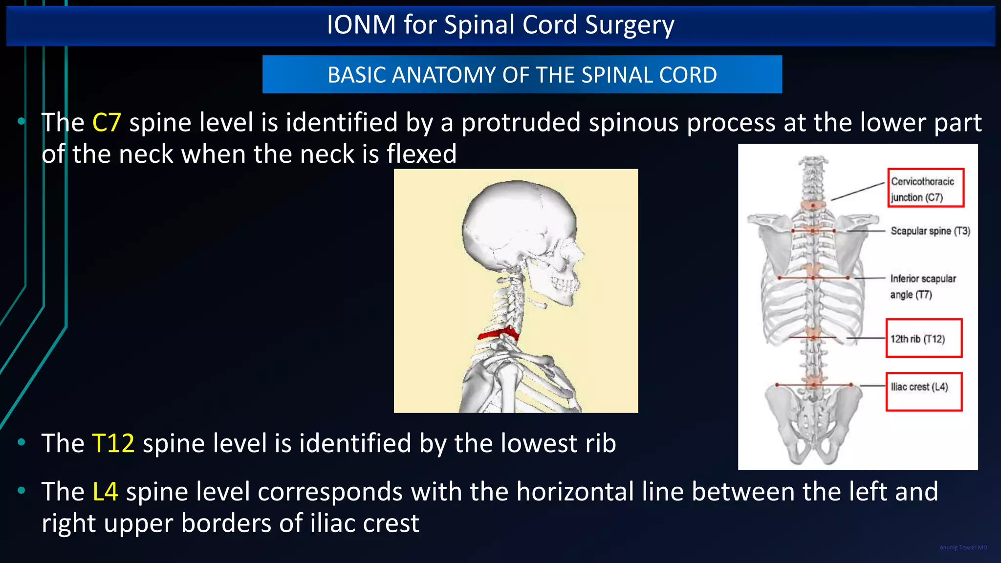 IONM for Spinal Cord Surgery | PPTX