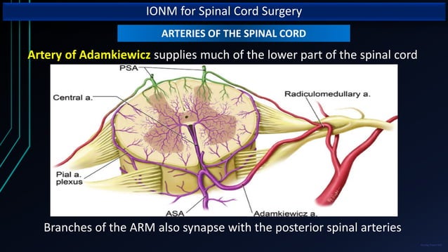 IONM for Spinal Cord Surgery | PPT