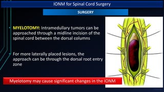 IONM for Spinal Cord Surgery | PPTX