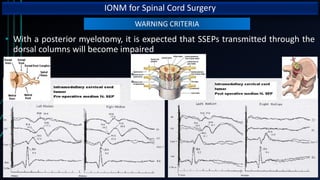 IONM for Spinal Cord Surgery | PPTX